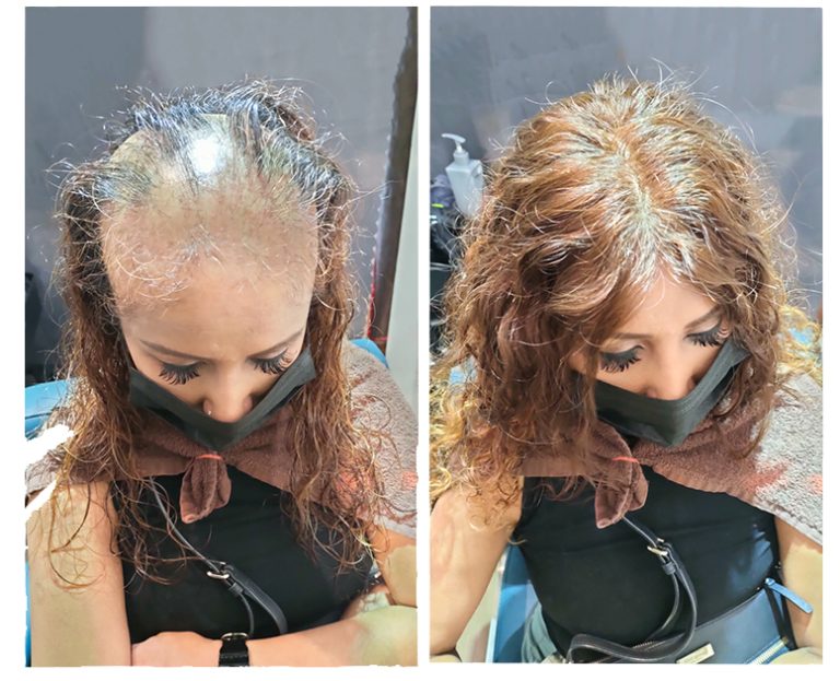 Non Surgical Hair Replacement System Singapore | Hair Transplant ...